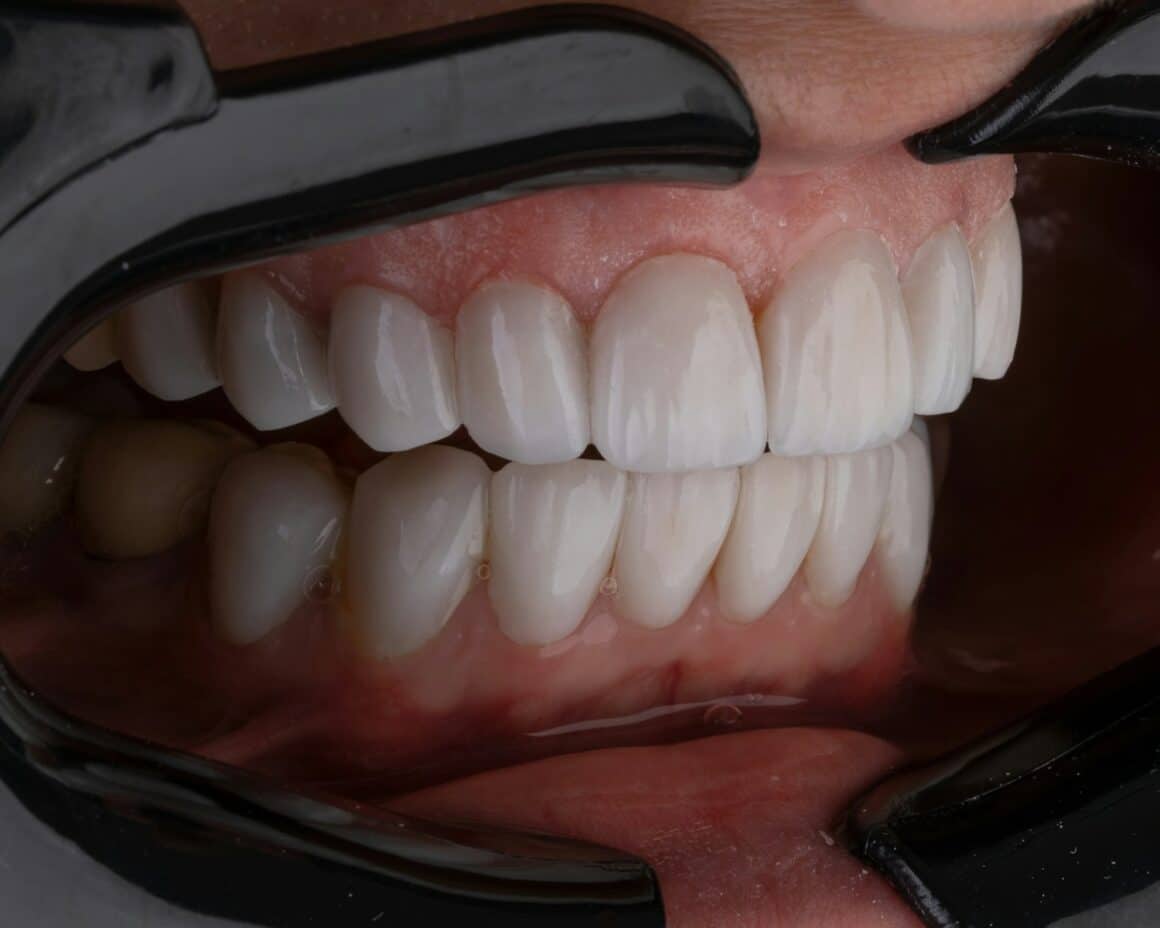 How to Clean New Dentures: Daily Steps + Travel-Friendly Tips - The ...